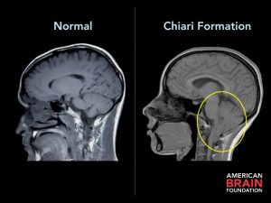 Chiari Malformation | American Brain Foundation