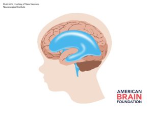 What Is Hydrocephalus? | American Brain Foundation