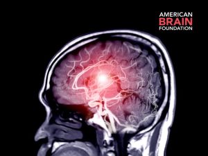 What Is Progressive Supranuclear Palsy (PSP)? | American Brain Foundation