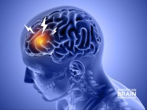 Angelman Syndrome | American Brain Foundation
