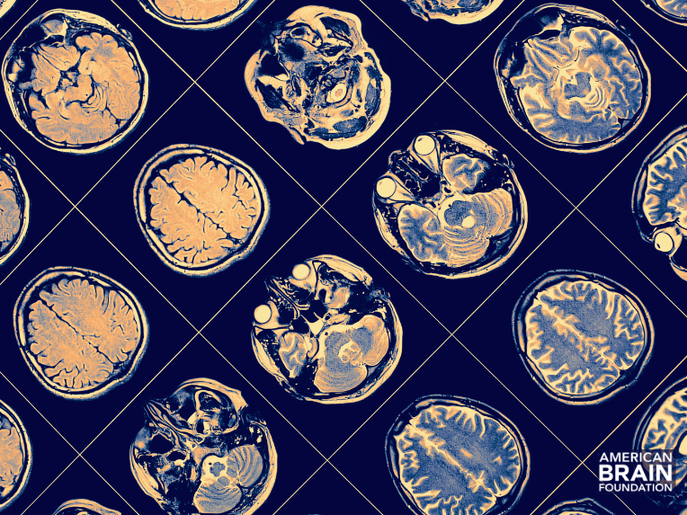 Adrenoleukodystrophy (ALD) - American Brain Foundation